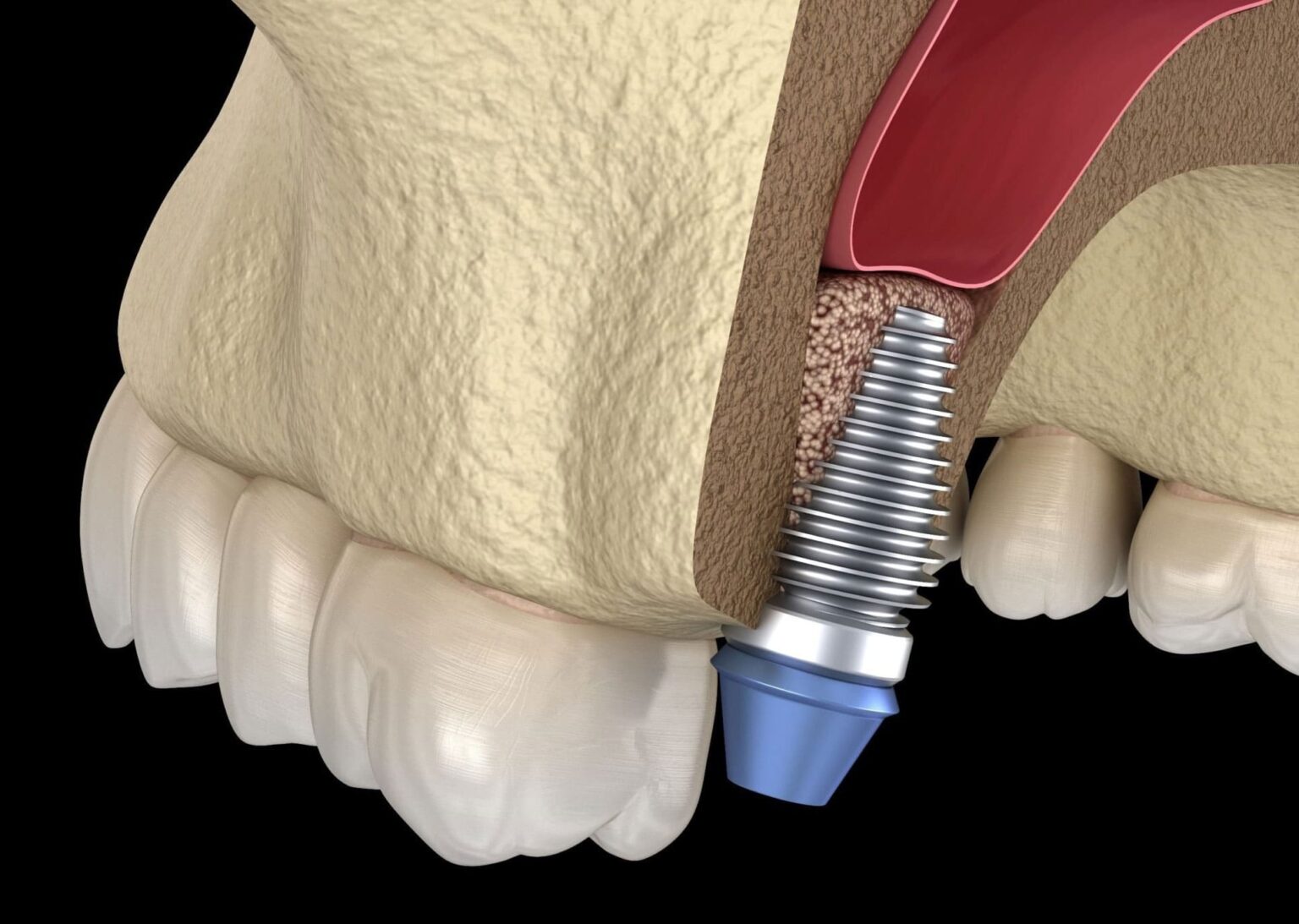 Bone Grafting for Dental Implants - Dentince Dental Clinic | Istanbul ...