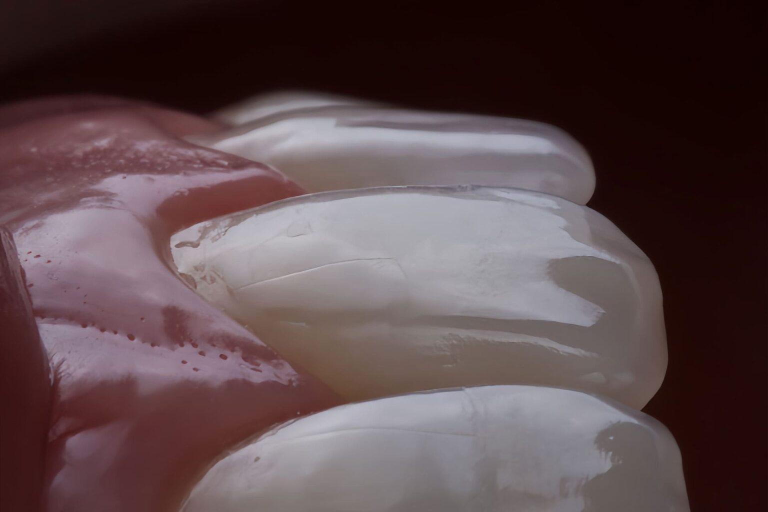 Laser Gum Contouring - Dentince Dental Clinic | Istanbul /Turkey