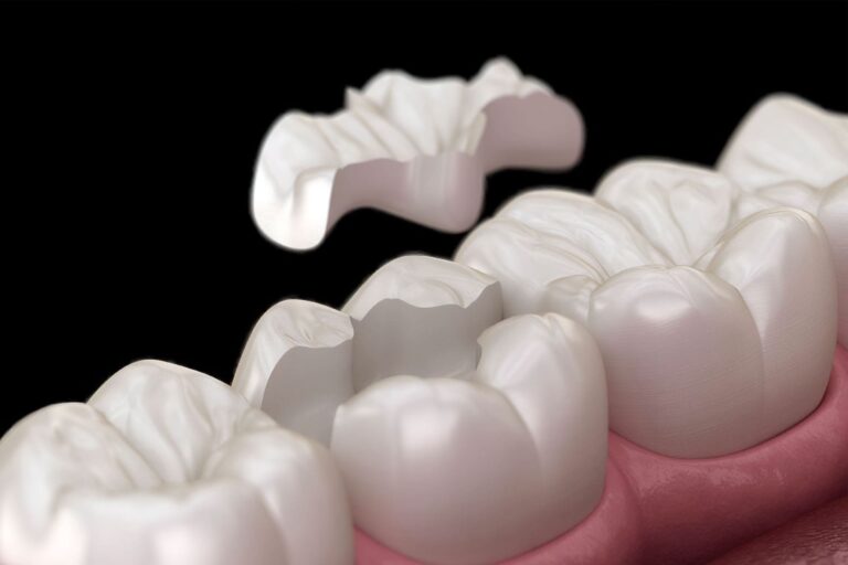 Inlay Onlay - Dentince Dental Clinic | Istanbul /Turkey